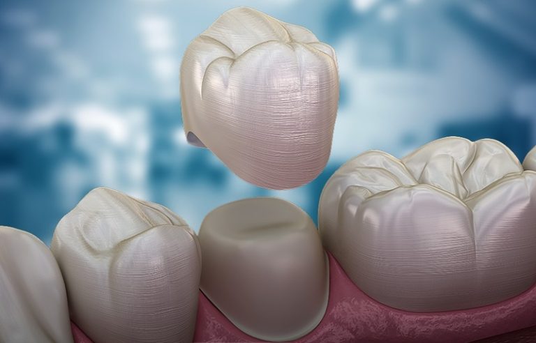 Endocrown vs Crown: What’s the Difference - Vision Dental Clinic